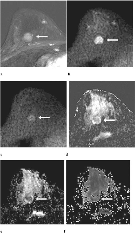 Figure 1 From Diffusional Kurtosis Imaging For Differentiation Of