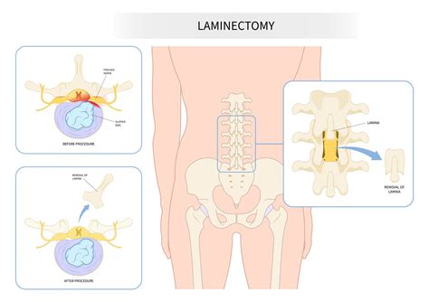 Laminectomy Decompression Recovery