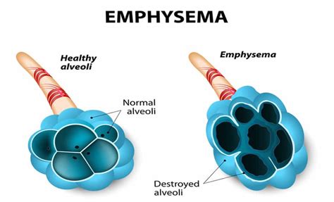 Emphysema Expand A Lung
