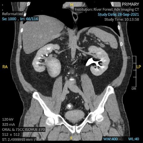 Chronic Appendicitis The Lesser Known Form Of Appendiceal Inflammation