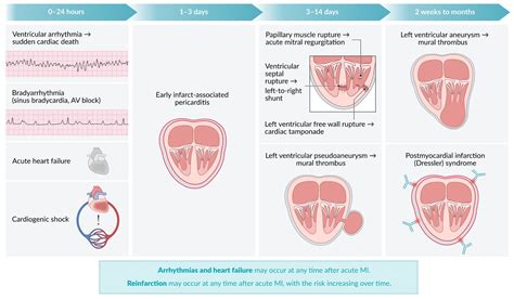 Myocardial Infarction Treatment Protocol