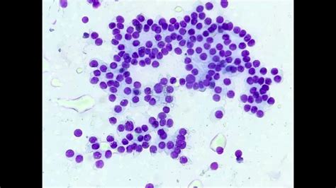 Chemodectoma Aortic Body Tumour In Dog Youtube