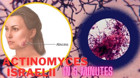 Actinomyces Microbiology Lecture Actinomyces Israelii Easy