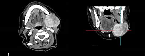 Malignant Peripheral Nerve Sheath Tumour Arising In The Submandibular