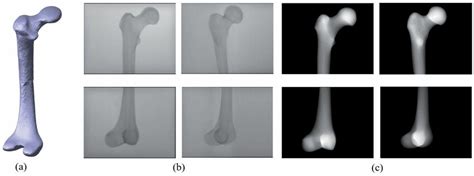 A Deformed 3 D Model In Which The Deformation Of The Anteversion