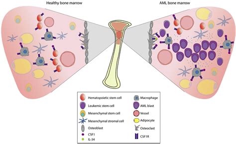 Pathophysiology Of Aml In The Bone Marrow The Bone Marrow Is A Download Scientific Diagram