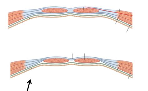 Rectus Sheath Diagram Quizlet