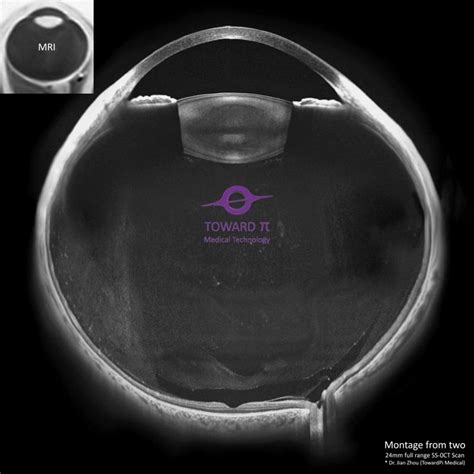 To Edit A “whole Eye” Oct Image Has Always Been In My To Do List For