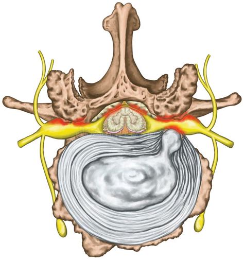 Stenosis Lumbar Disk Herniation Stock Illustration Illustration Of