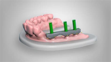 Kls Martin Ips Implants Preprosthetic®