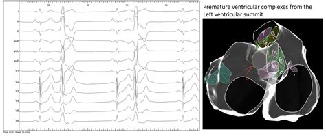Left Ventricular Summit For Ablation Cardiac Anatomy For Electrophysiologist
