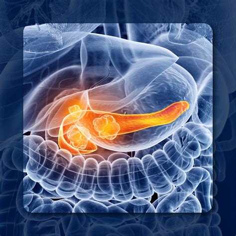 First Line Folfirinox Fails To Improve Os Vs First Line Nalirifox In