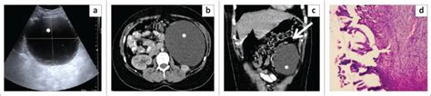 Ultrasound And Computed Tomography In The Evaluation Of Mesenteric