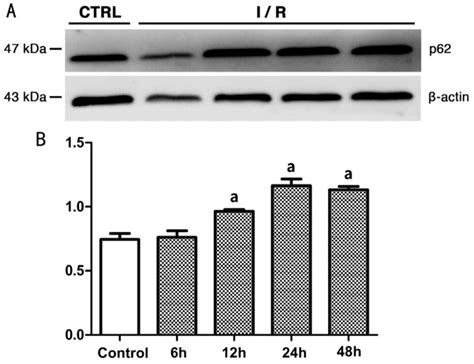 Expression And Role Of Autophagy Related Protein P62 And Lc3 In The