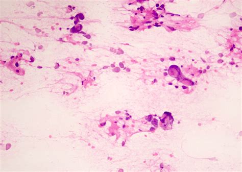 Pathology Outlines Pleomorphic Xanthoastrocytoma