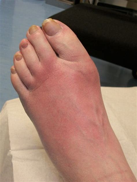 Acute Charcot Foot The Bmj