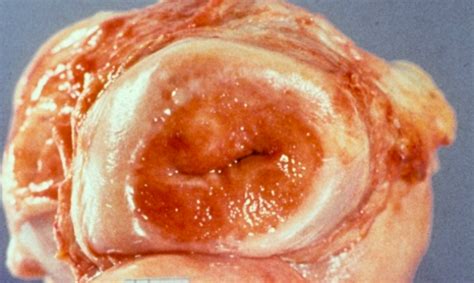 Path Cervix Flashcards Quizlet