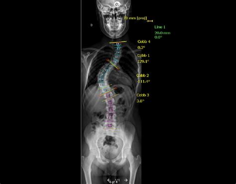 Anteroposterior Panoramic Radiograph Illustrating Cobb 1 Corresponds