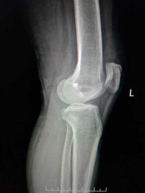 髌骨纵形骨折手术治疗