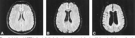 Figure 1 From Use Of The Brain Parenchymal Fraction To Measure Whole Brain Atrophy In Relapsing