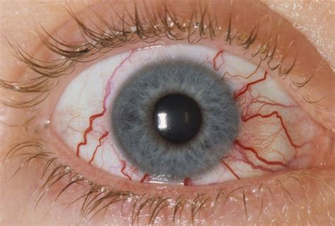 Moran CORE Scleritis