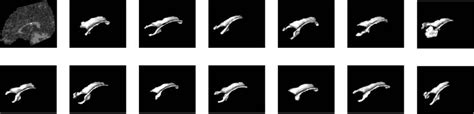 automatic segmentation of the corpus callosum cc using the odf flow