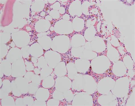 Bone Marrow Biopsy Core Biopsy Showing Hypocellularity Overall 10 Download Scientific