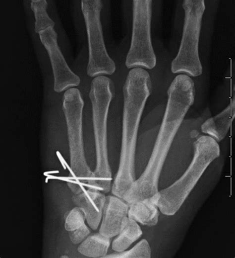 Fractures Of The Metacarpals And Phalanges Clinical Tree