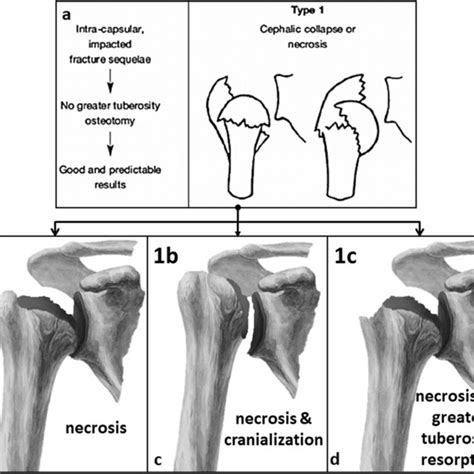 Neer Classification Of Humeral Head Fractures At Patrick Jefferson Blog