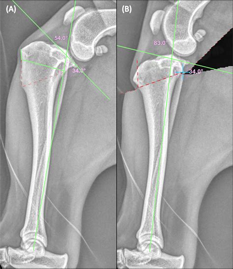 A Mismatch Of Planning And Achieved Tibial Plateau Angle In Cranial