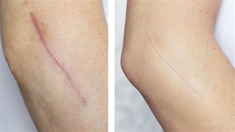 Osteotomy Indications Types Contraindications Principles And