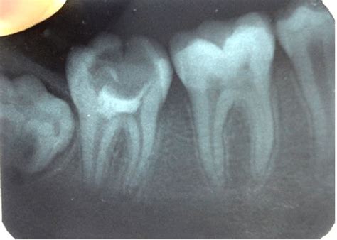Pulpotomy Performed Fig 5 Mta Placed Fig 6 Immediate Postoperative