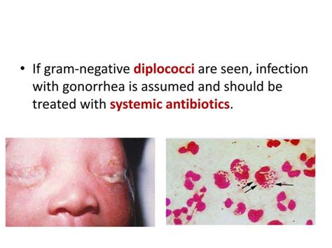 Diagnosis And Management Of Pediatric Conjunctivitis Pptx Ear Nose
