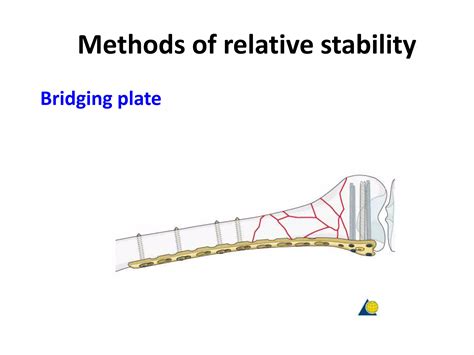 Principles Of Locking Compression Plates Pptx