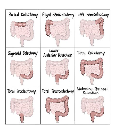 What Kinds Of Surgery Are There Colontown University