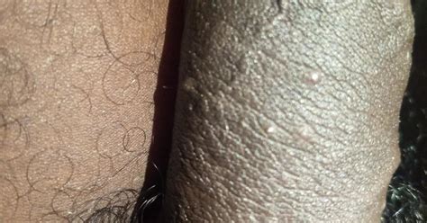 Small Bumps On Penis Shaft