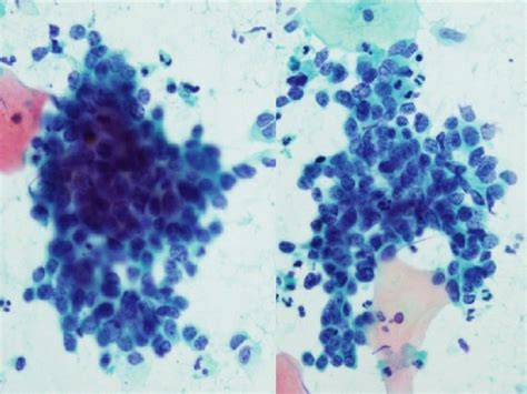 Cytologic Features Background Necrotic Tumor Diathesis Cellularity Moderate