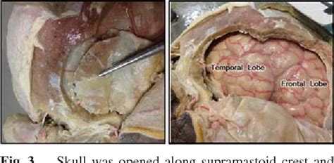 Suprameatal Crest Norma Lateralis Earths Lab