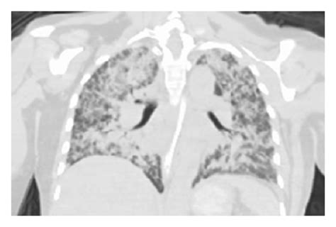 Ct Thorax Demonstrating Diffuse Airspace Opacities Involving Bilateral