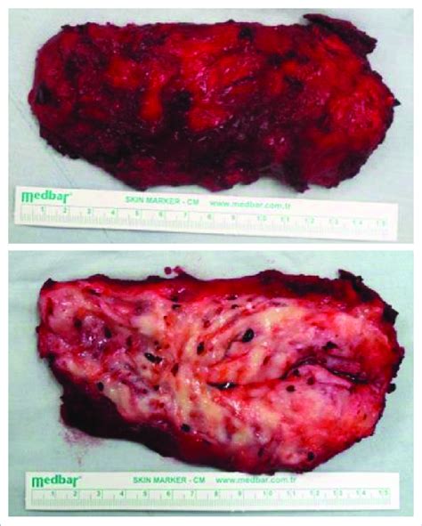 Resected And Incised Specimen Just After Surgery Download Scientific