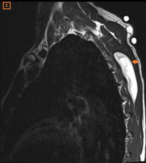 A Case Of Myxoma Mimicking Scapulothoracic Bursa Pmc