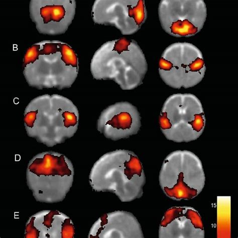 Analysis Of Eeg Connectivity Using Spatial Amplitude Correlations In