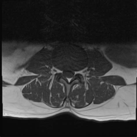 Radiopaedia Case Discitis Osteomyelitis Eikenella Corrodens Id 46558