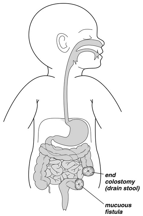 Pediatric Ostomy Care At Becky Uhl Blog
