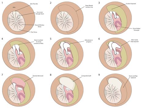 Mastoidectomy Enteducationswansea