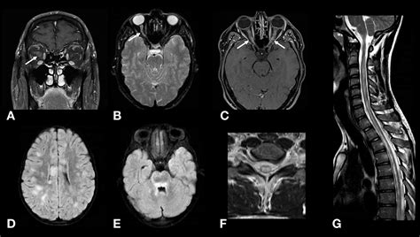 Mogad Mog Antistof Gerelateerde Ziekte Tnn