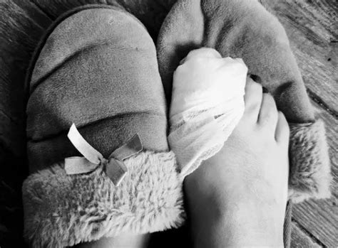 Temps De Guérison Dun Orteil Cassé Tout Ce Que Vous Devez Savoir