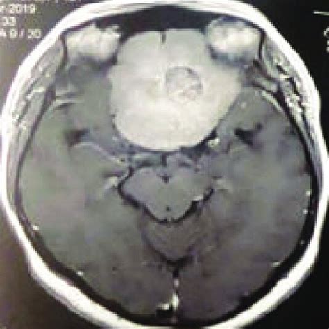 Small Extended Bi Frontal Craniotomy Download Scientific Diagram