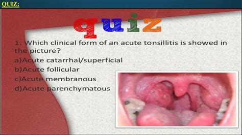 Acute Catarrhal Tonsillitis