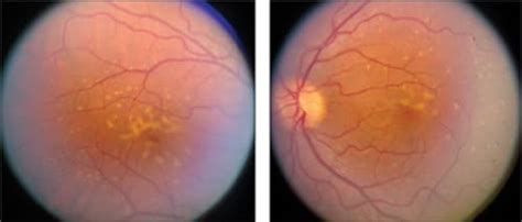 Peer Reviewed Pattern Dystrophy Of The Retinal Pigment Epithelium